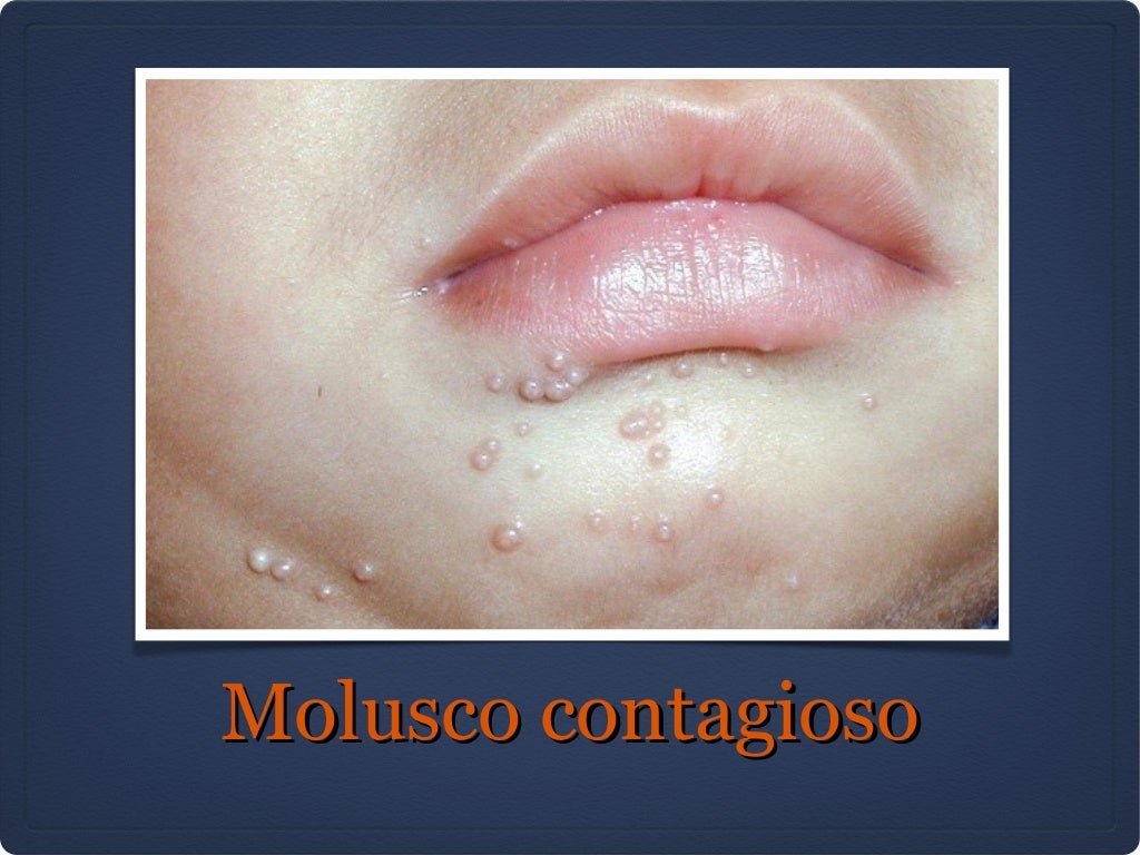 Molusco contagioso