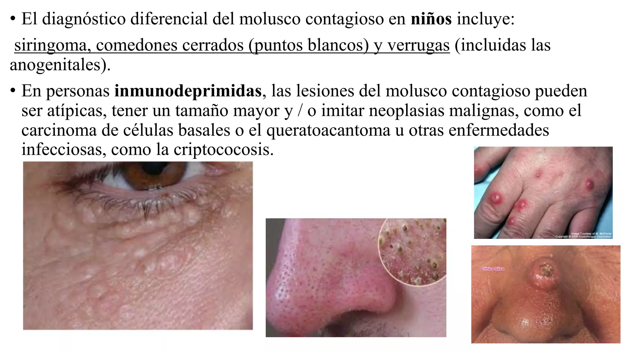 Molusco contagioso | PPTX