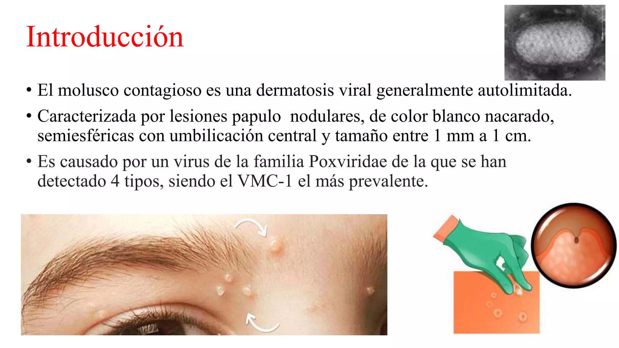 Molusco contagioso | PPTX