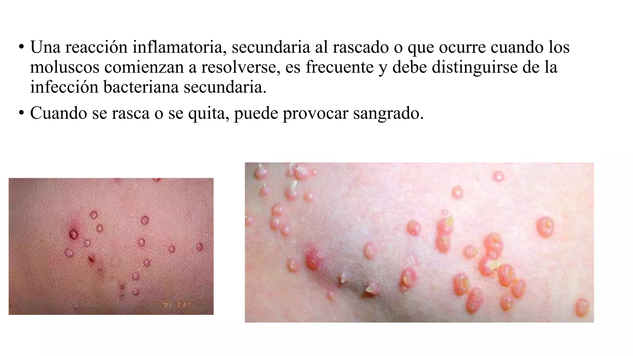 Molusco contagioso | PPTX
