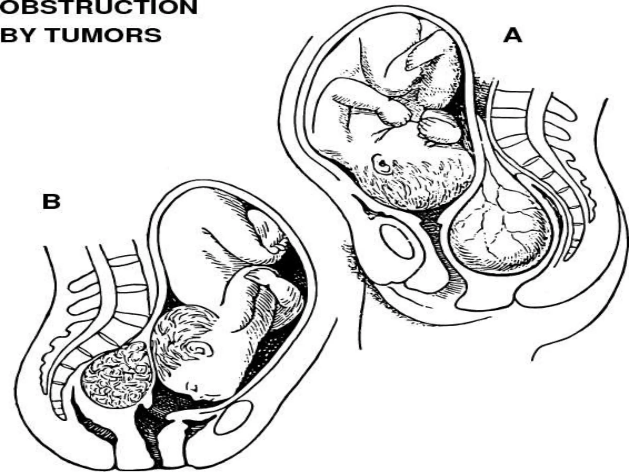 Obstructed Labour ppt | PPTX