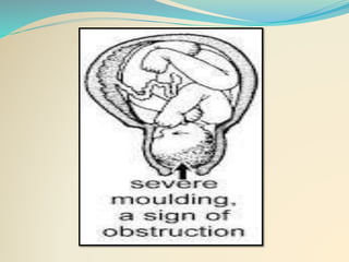 Obstructed Labour ppt | PPTX