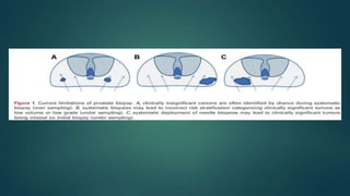Mon 8-00 Prostate Cancer Screening in the Post-USPSTF Era_0.pptx