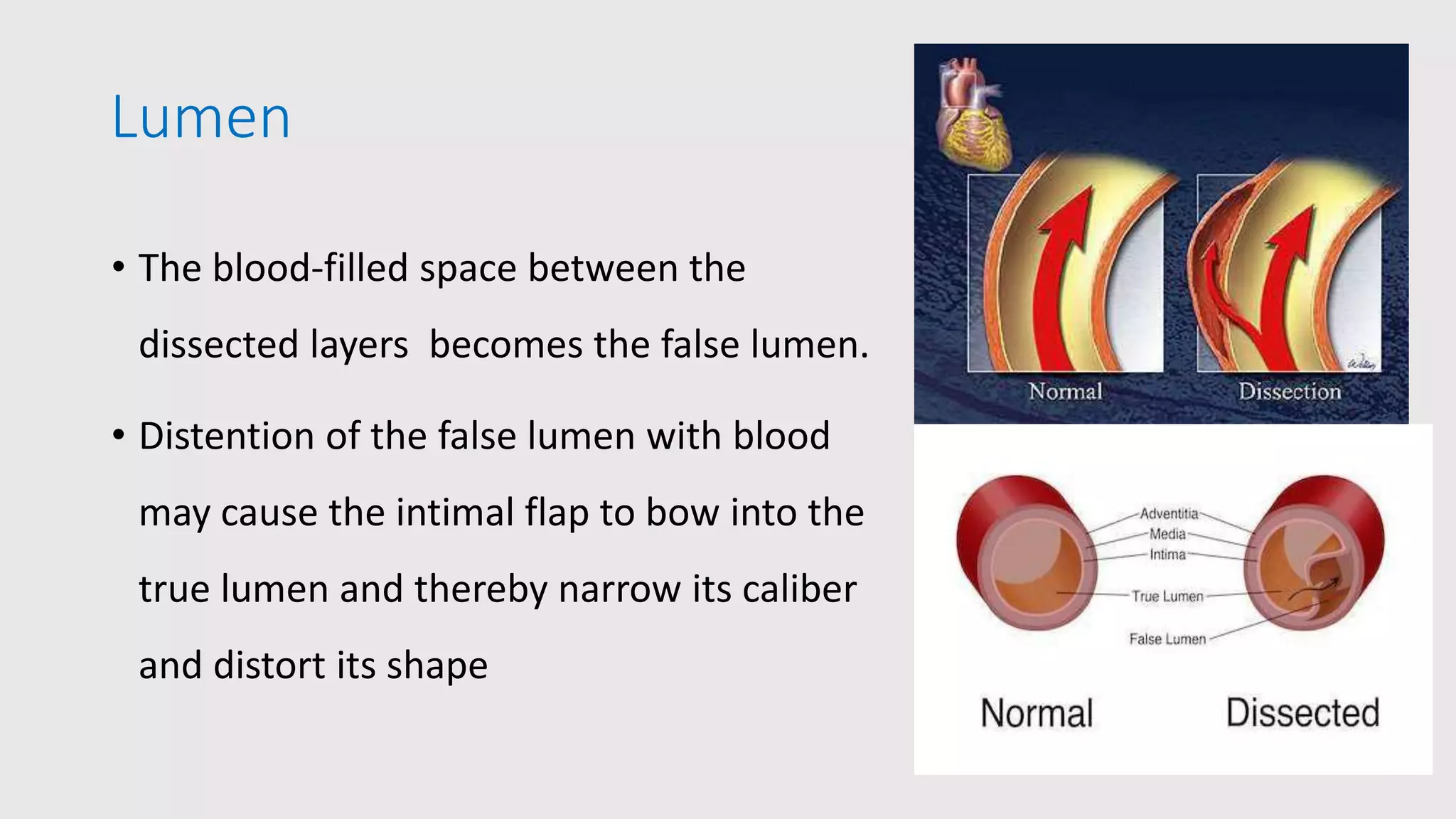 Aortic Dissection | PPTX