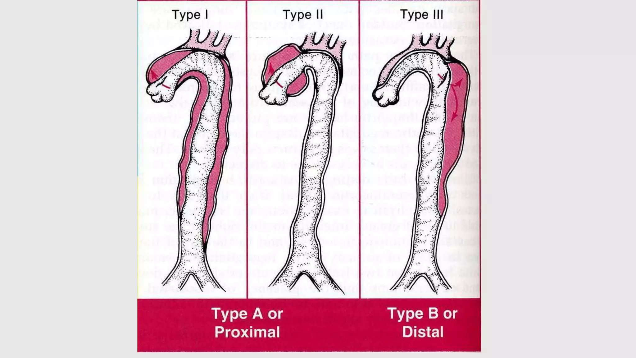 Aortic Dissection