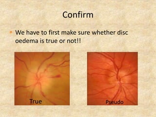 Approach to a case of disc oedema | PPT