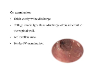 Moniliasis(Candida vaginitis) | PPT