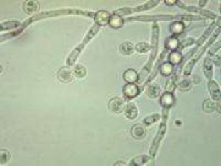 Monilijaza kandidijaza | PPTX