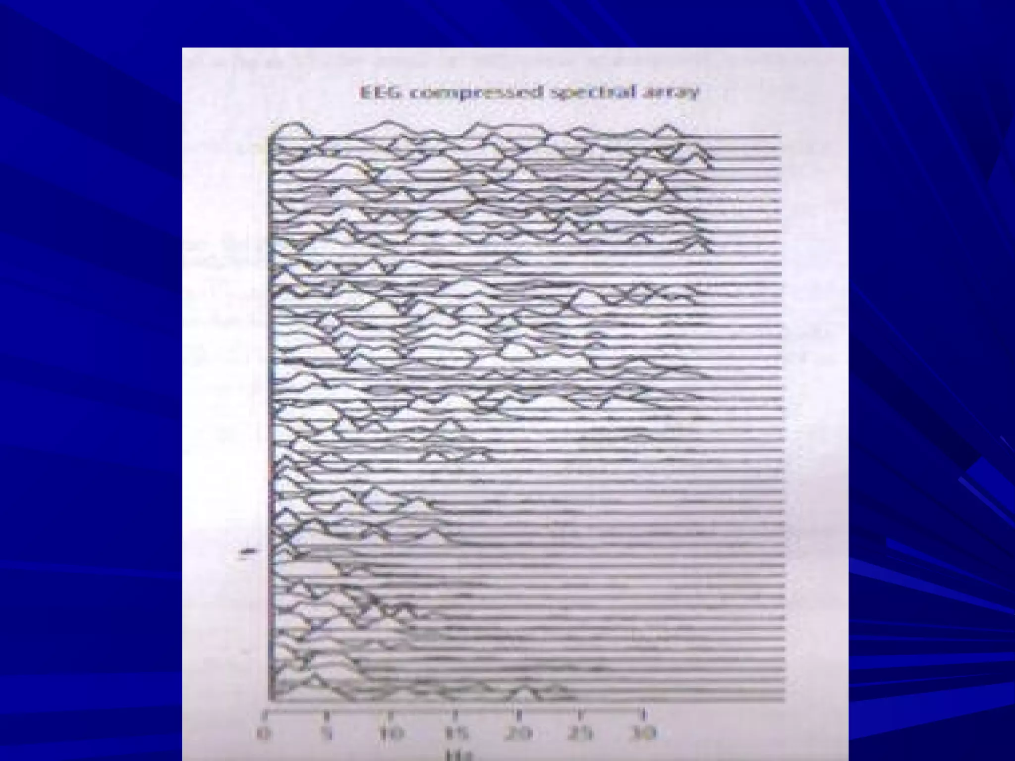 Monitoring depth of anaesthesia | PPT