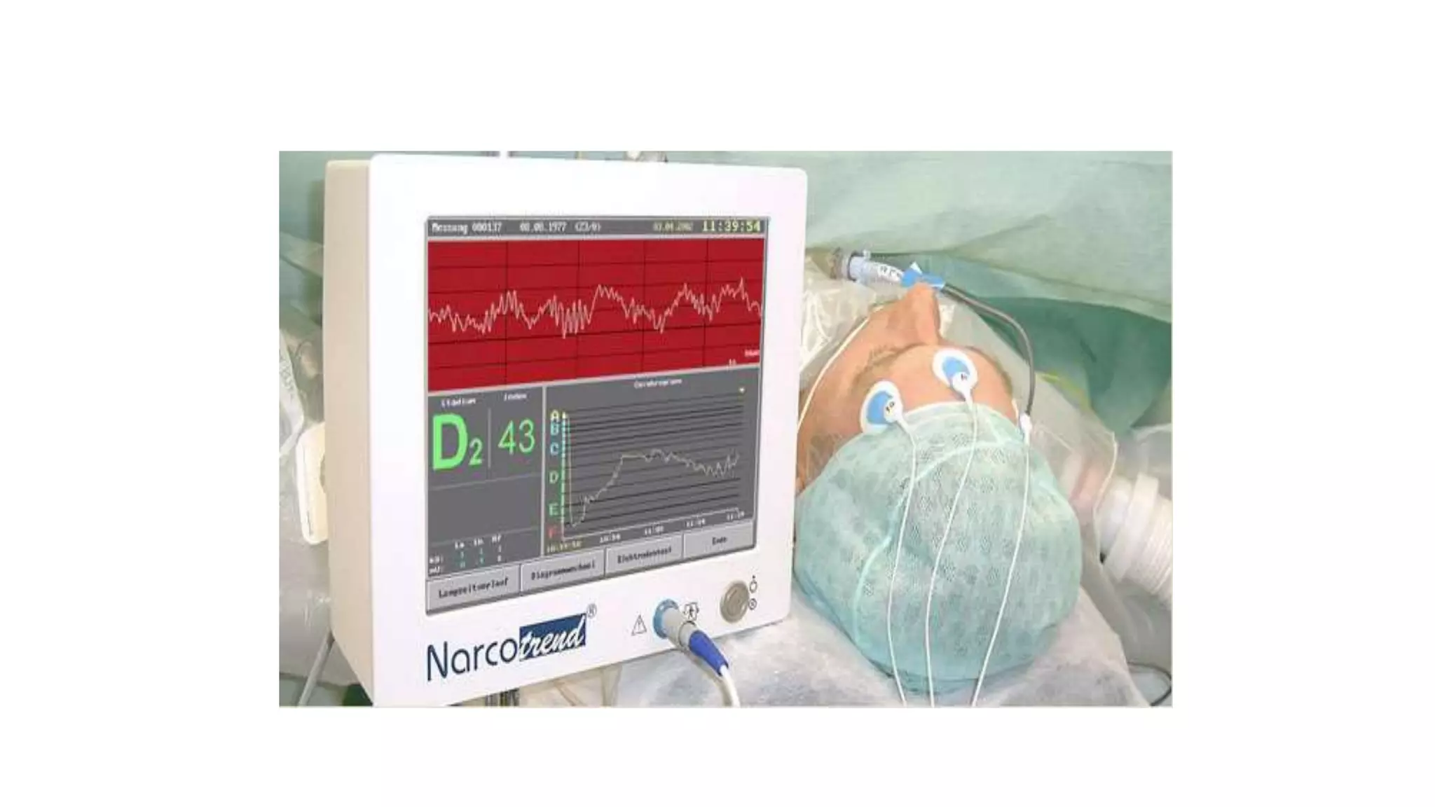 Monitoring depth of anesthesia | PPTX
