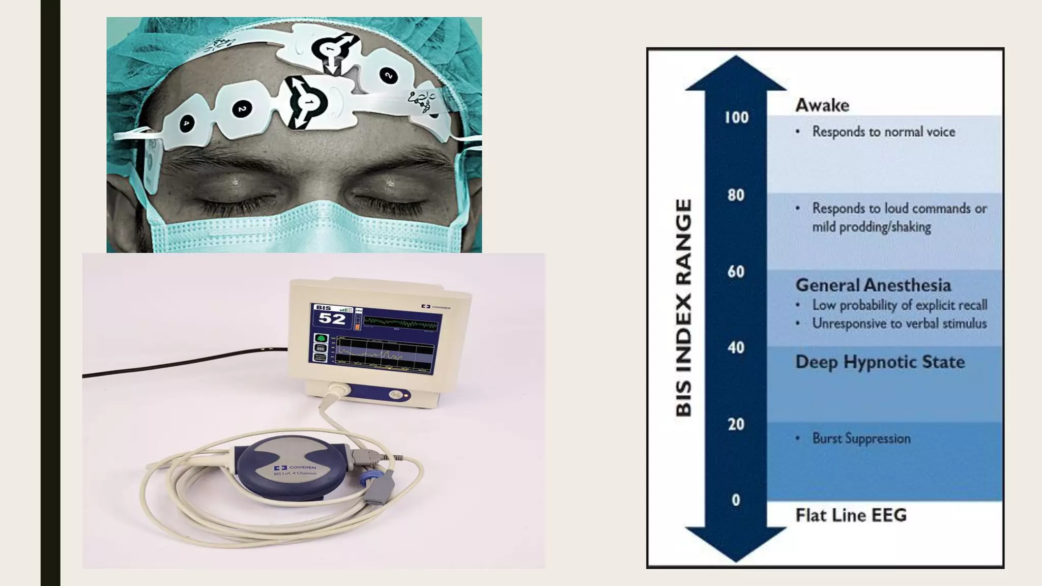 Monitoring Depth of Anaesthesia | PDF