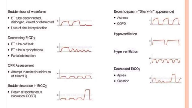 BASIC MONITORING IN ANAESTHESIA PRESENTATION.pptx | Lung and ...