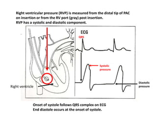 Monitoring in cardiac ananesthesia | PPTX