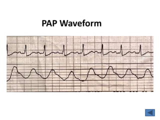 Monitoring in cardiac ananesthesia | PPTX