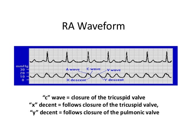 Monitoring in cardiac ananesthesia