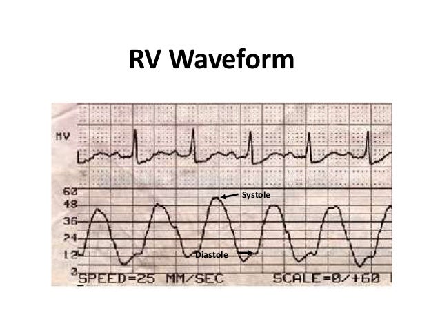 Monitoring in cardiac ananesthesia