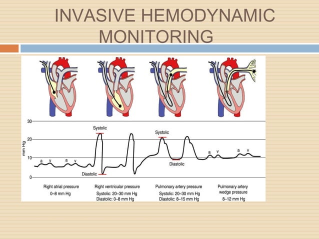 Monitoring in ICU | PPT | Heart and Cardiovascular Diseases | Diseases ...