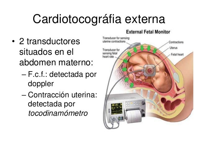 Monitorización fetal intraparto