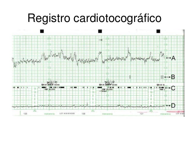 Monitorización fetal intraparto