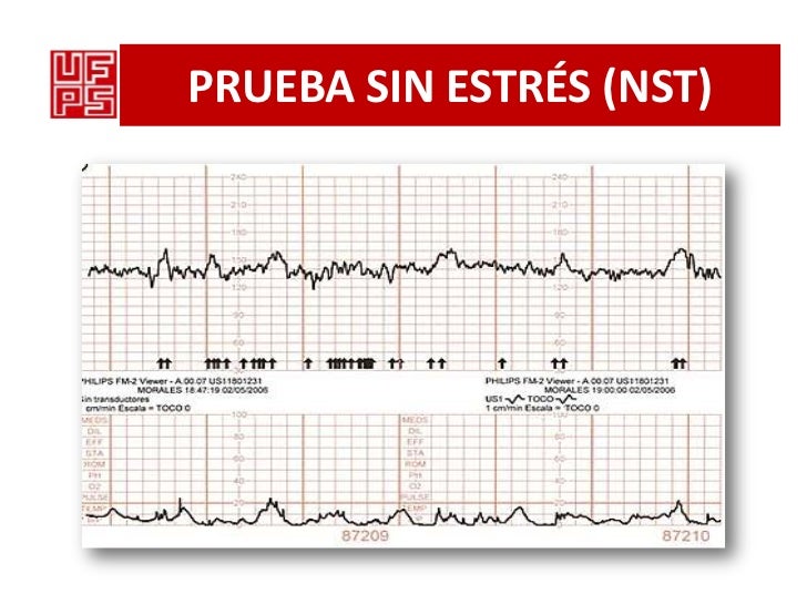 Monitorizacion fetal