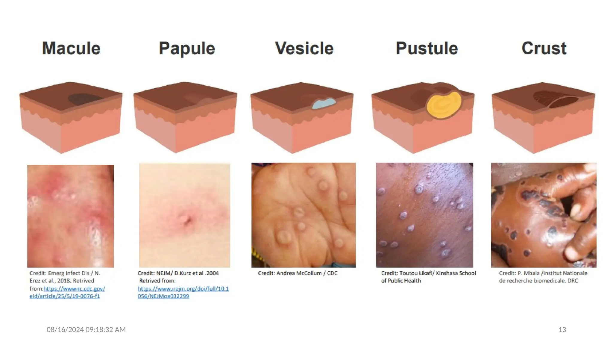 Monkey pox disease: world's new problem | PPTX