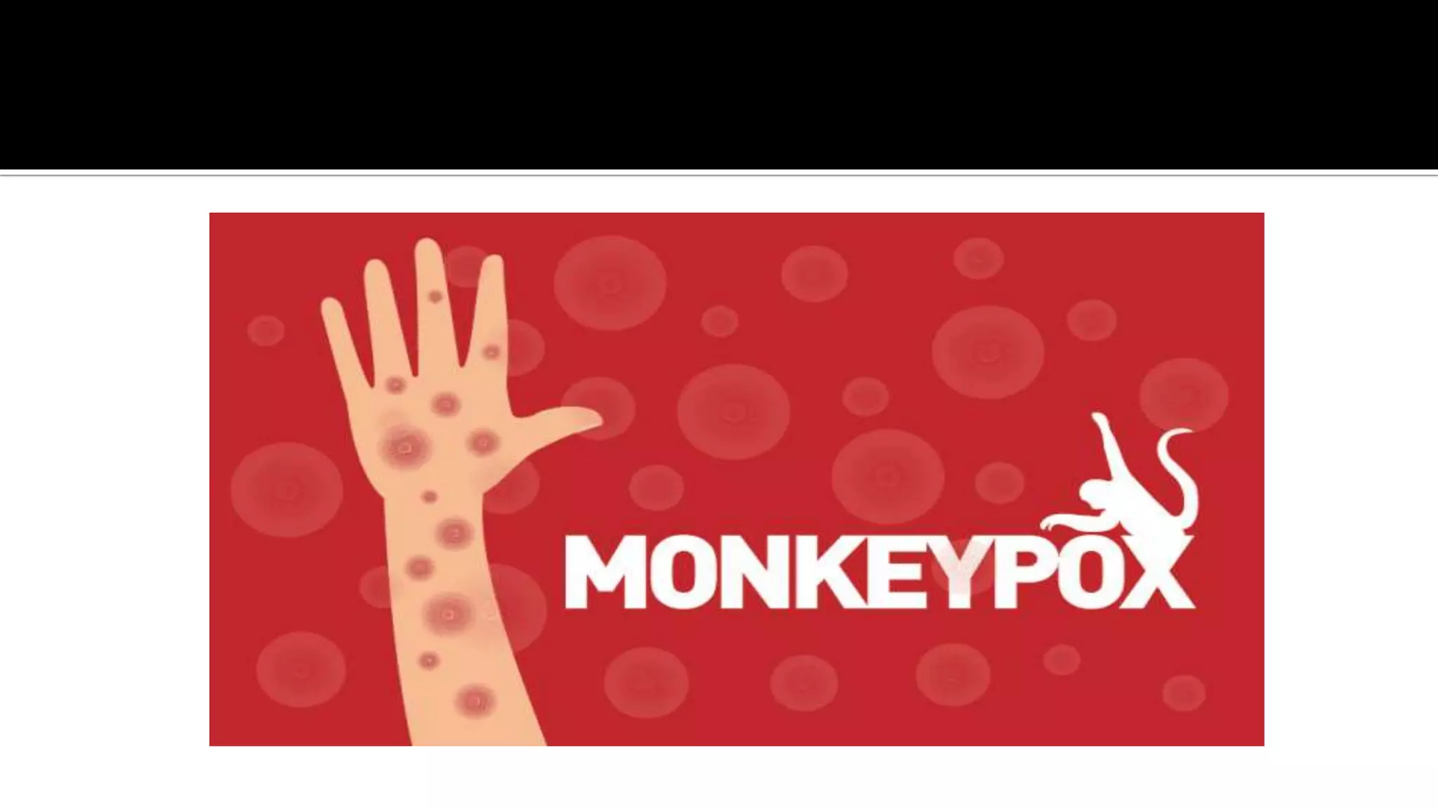 Monkey pox. (Anosh Nathaniel) | PPTX | Infectious Diseases | Diseases and Conditions