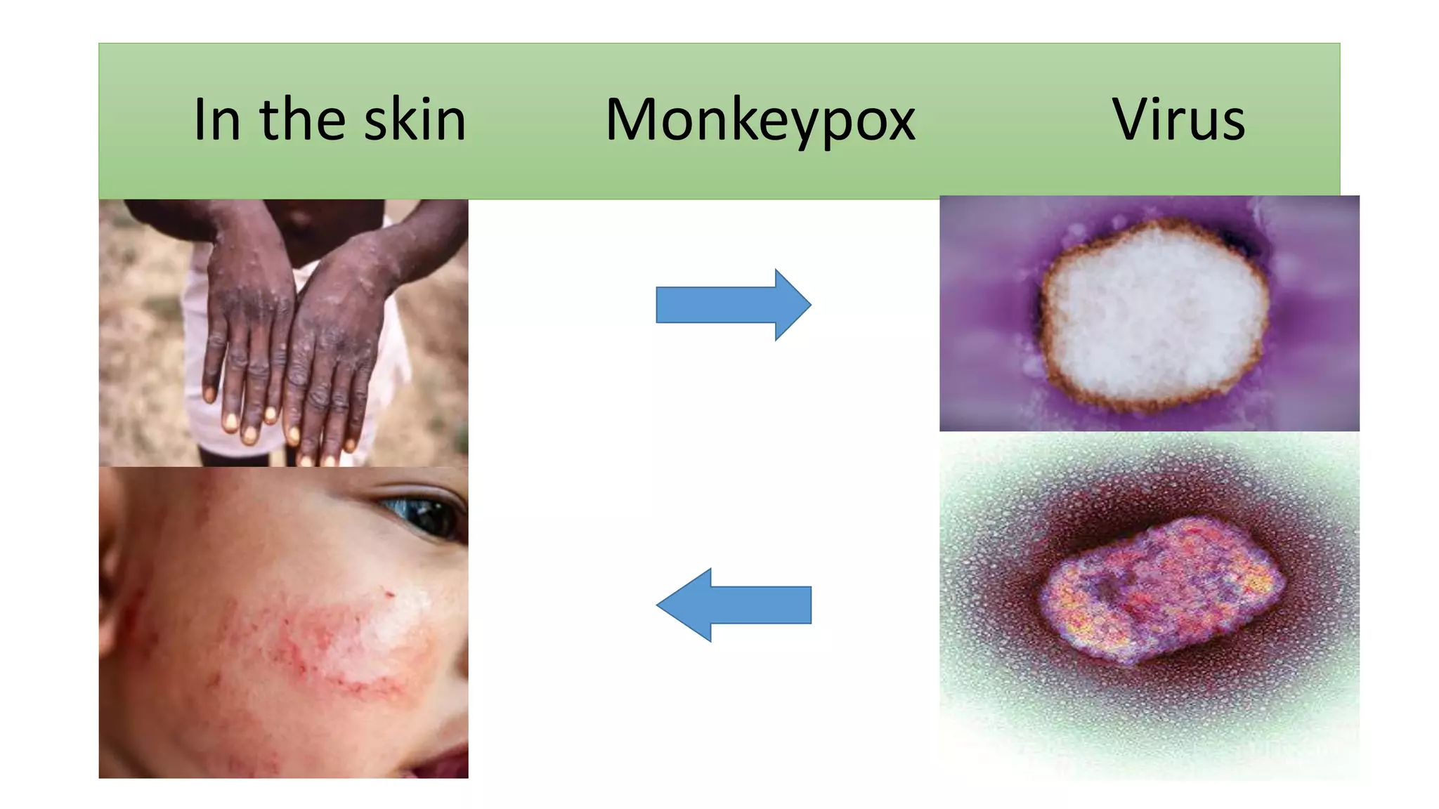 Monkey pox.pptx