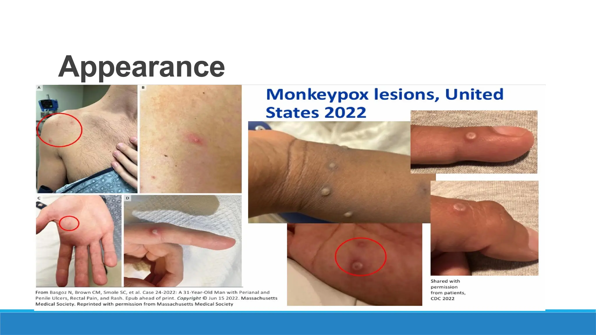 monkeypox.pptx Mpox outbreak/ spread and control | PPTX