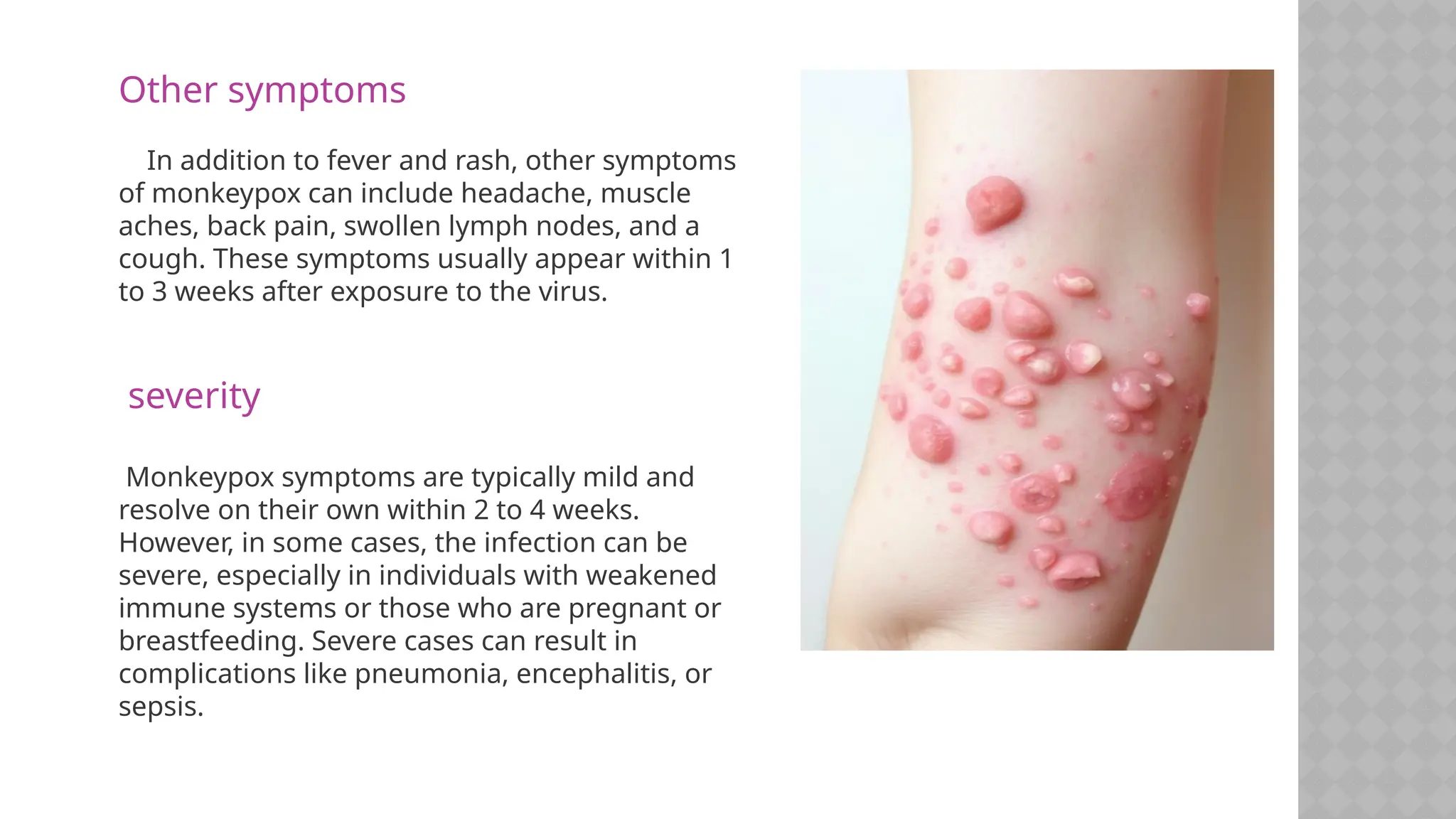 Monkey pox 24.medical surgical nursing ppt | PPTX
