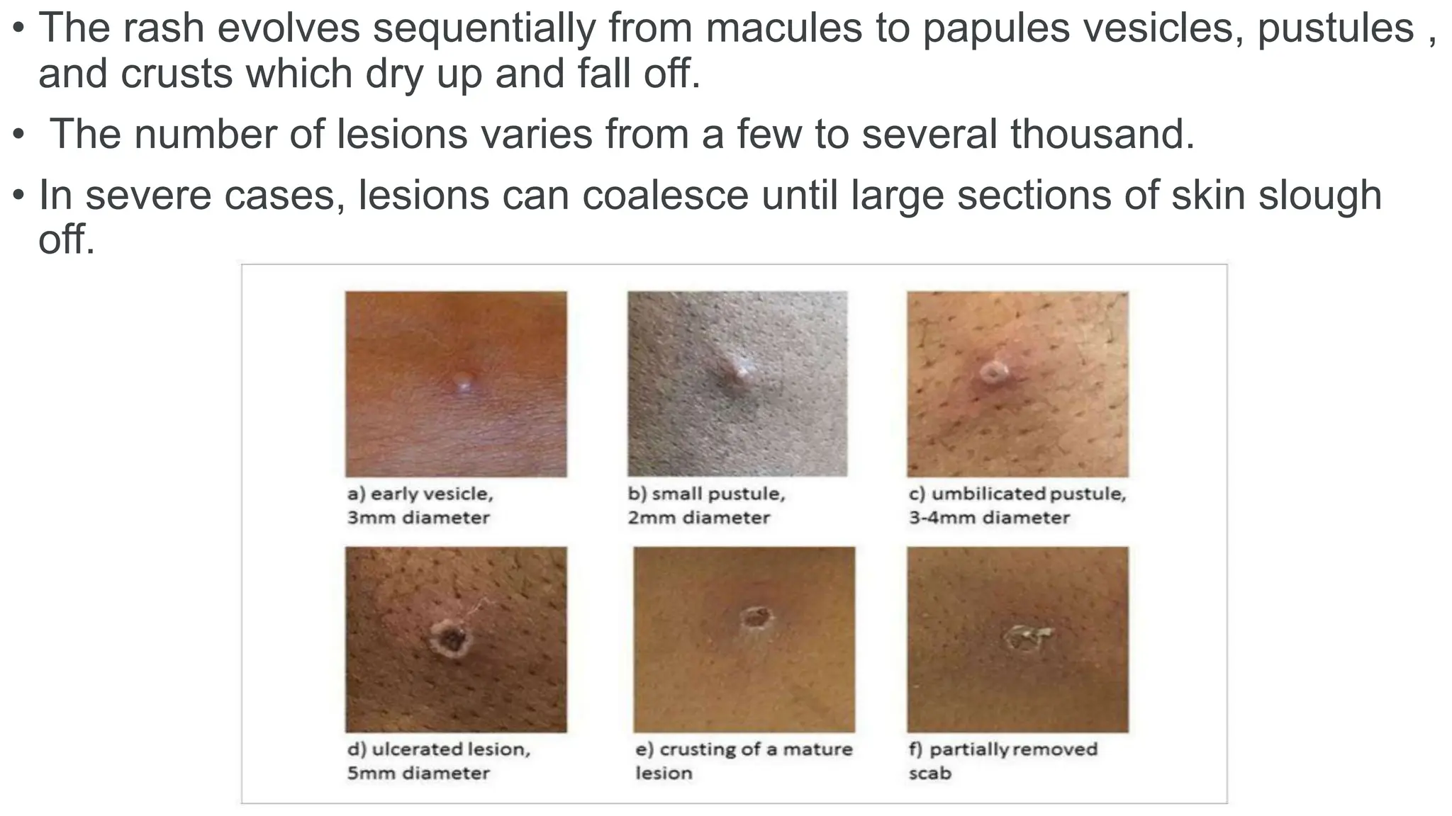 Monkey Pox , a global health emergency . | PPTX