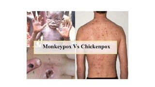 Monkeypox [Autosaved].ppt