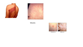 Monkeypox [Autosaved].ppt