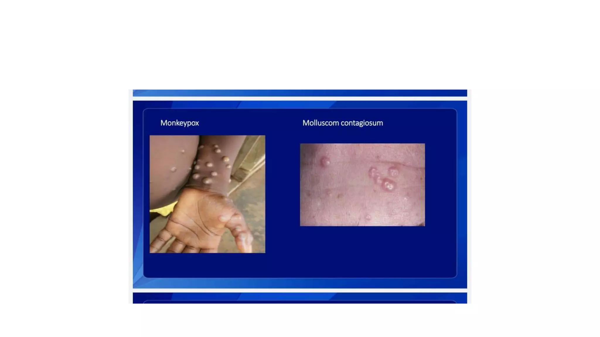 MONKEYPOX PRESENTATION .pptx