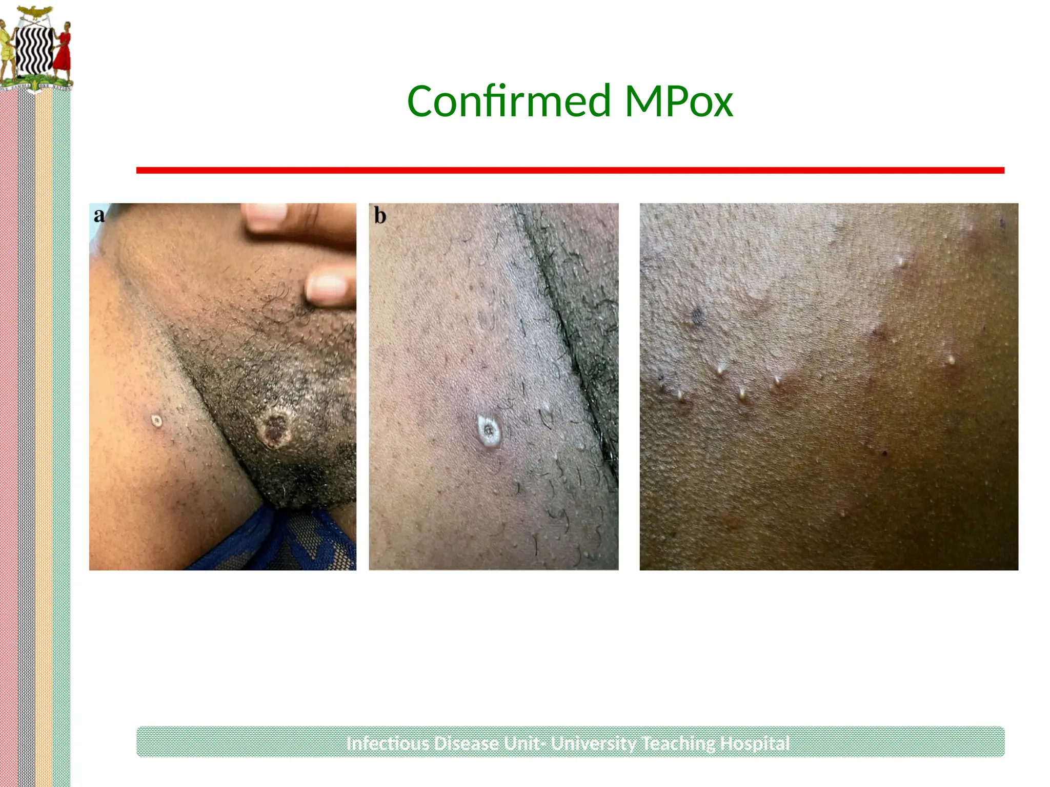 Monkey Pox slides; Get to learn the risk factors,presentation and management of Mpox | PPTX