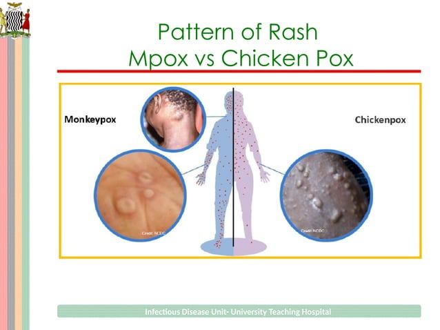 Monkey Pox slides; Get to learn the risk factors,presentation and ...