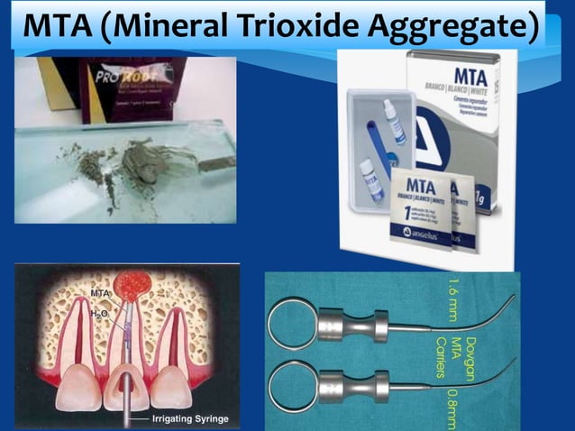 dental Monoblock obturation technique or concept in endodontics | PPTX ...