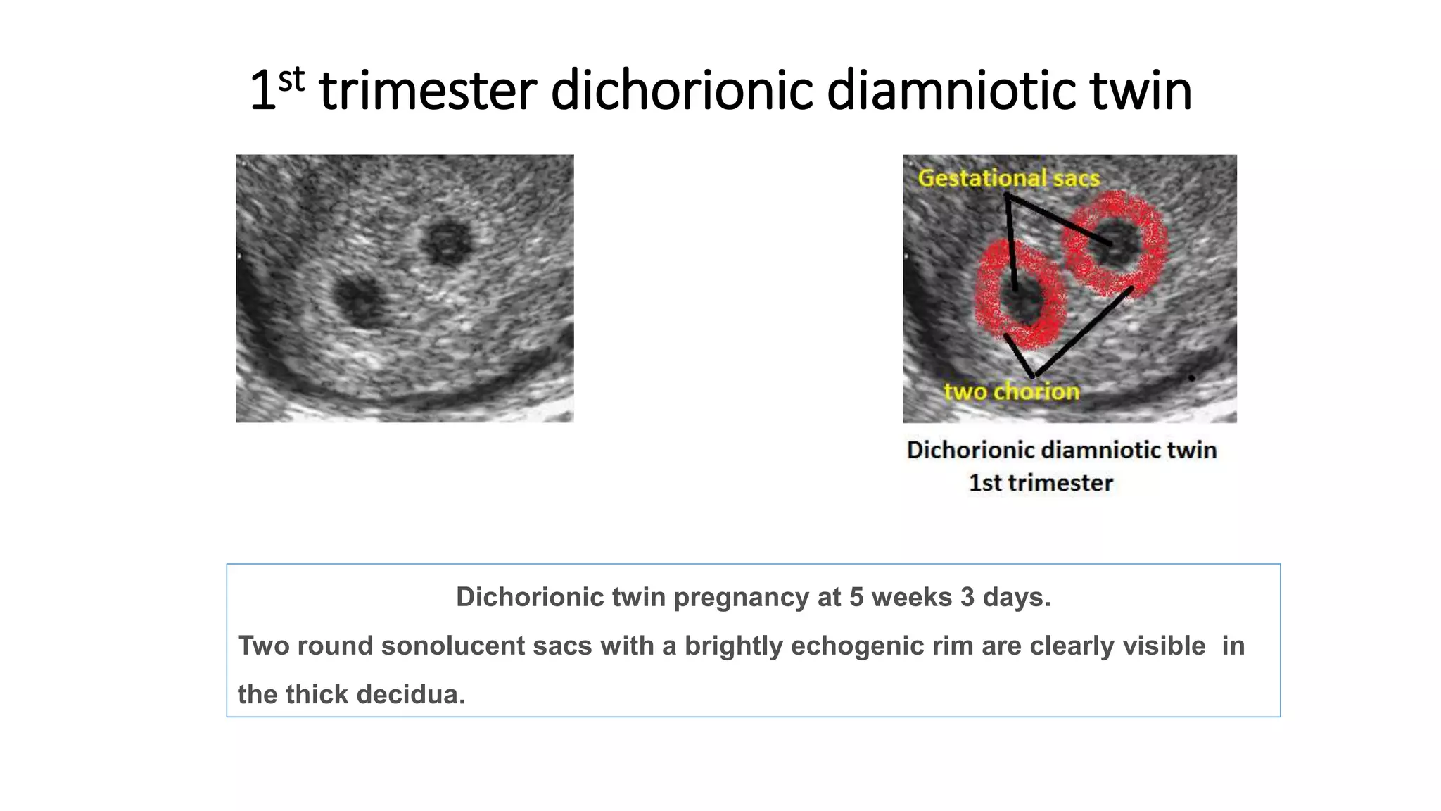 Anatomy of Monochorionic diamniotic twin | PPTX