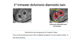 Anatomy of Monochorionic diamniotic twin | PPTX