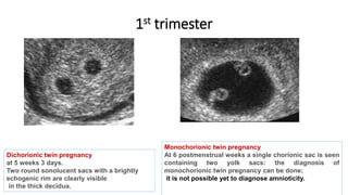 Anatomy of Monochorionic diamniotic twin | PPTX