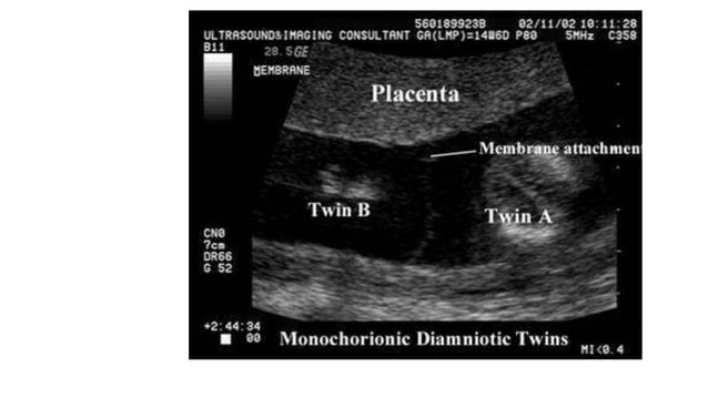 Anatomy of Monochorionic diamniotic twin | PPTX | Pregnancy ...