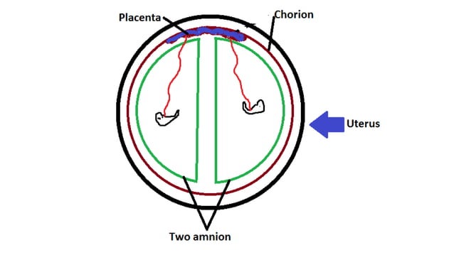 Anatomy of Monochorionic diamniotic twin | PPTX | Pregnancy ...