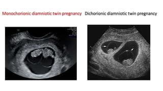 Anatomy of Monochorionic diamniotic twin