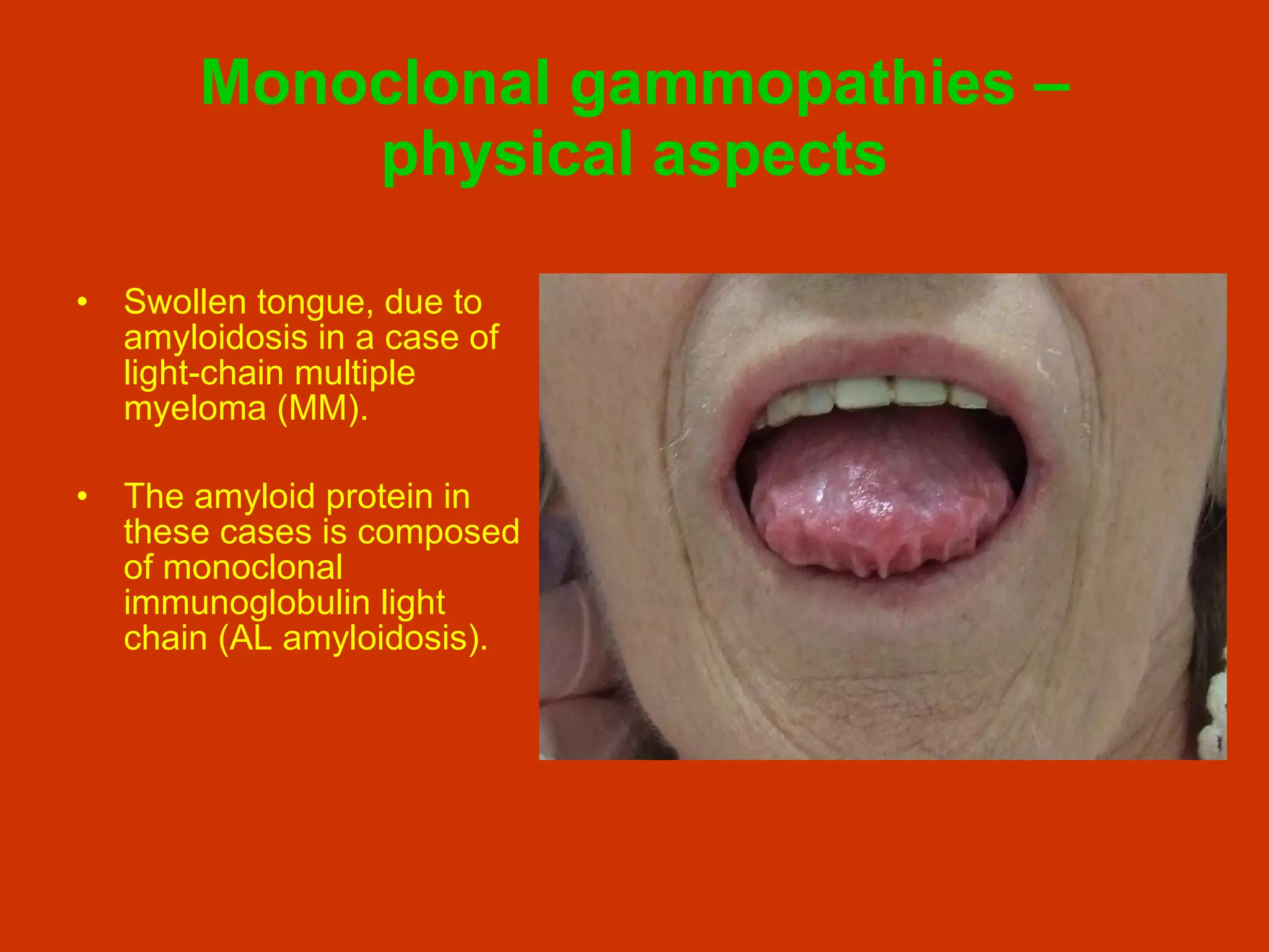Monoclonal Gammopathies | PPT