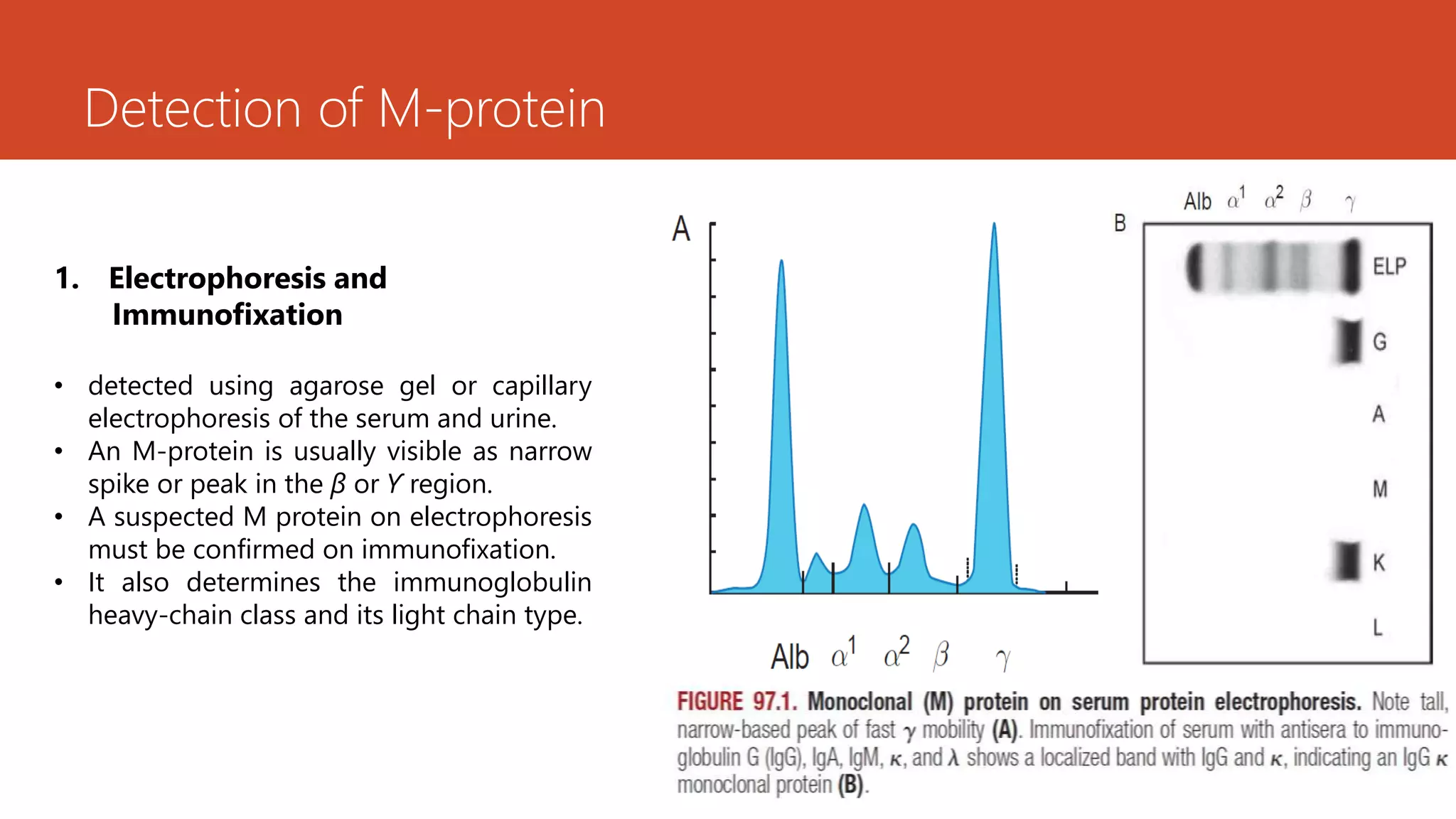 Monoclonal gammopathies of undetermined significance | PPTX