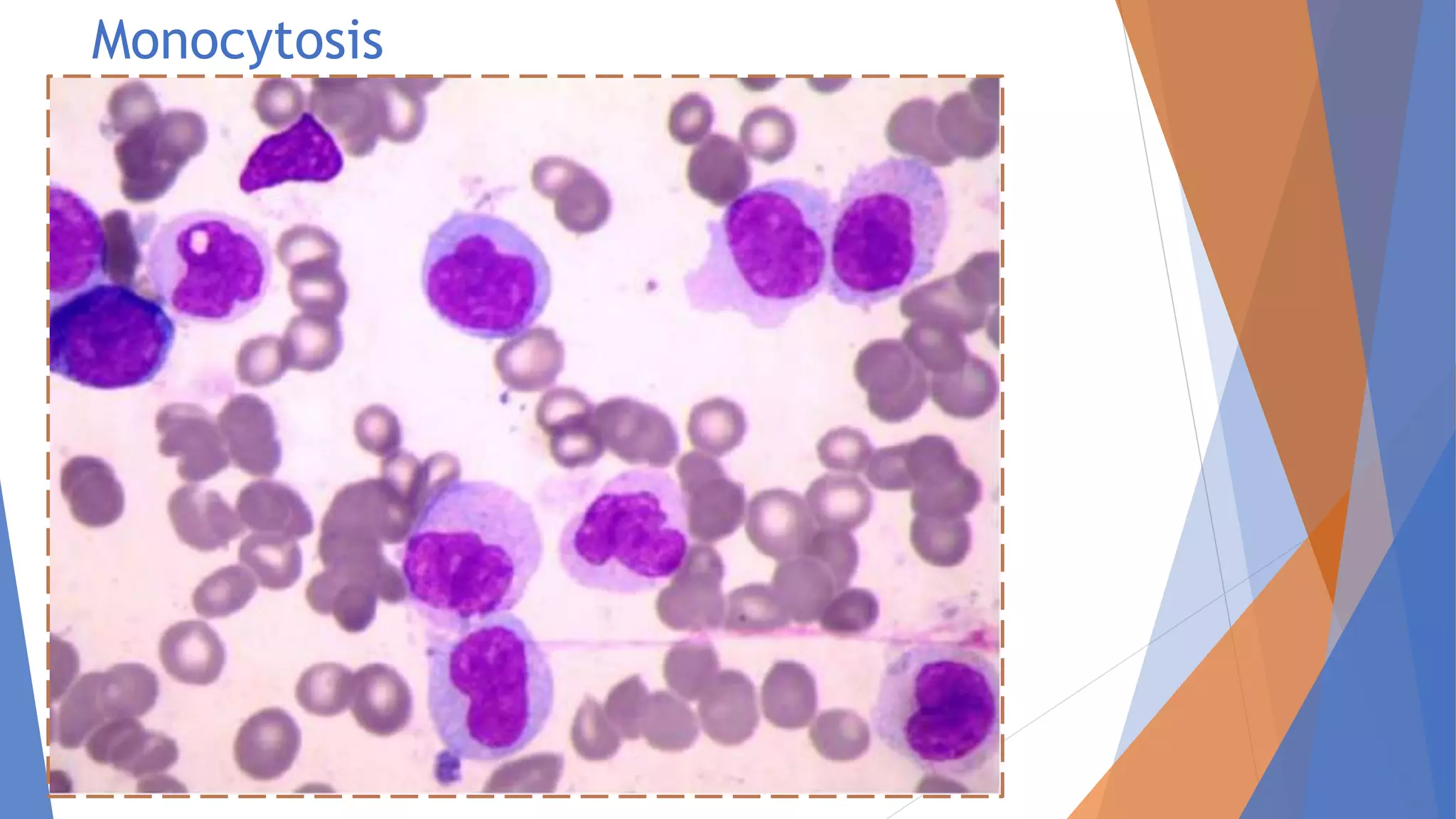 What is Monocytosis, By Doctor Rifat | PPTX