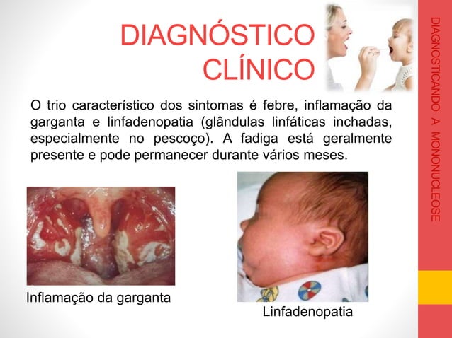 Caso clínico de mononucleose – mononucleosis tratamiento – Akapv