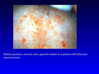 Mononucleosis | PPT