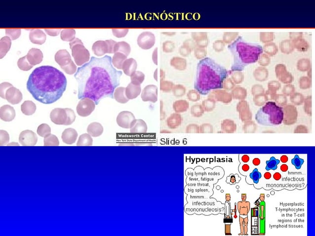 Mononucleosis | PPT