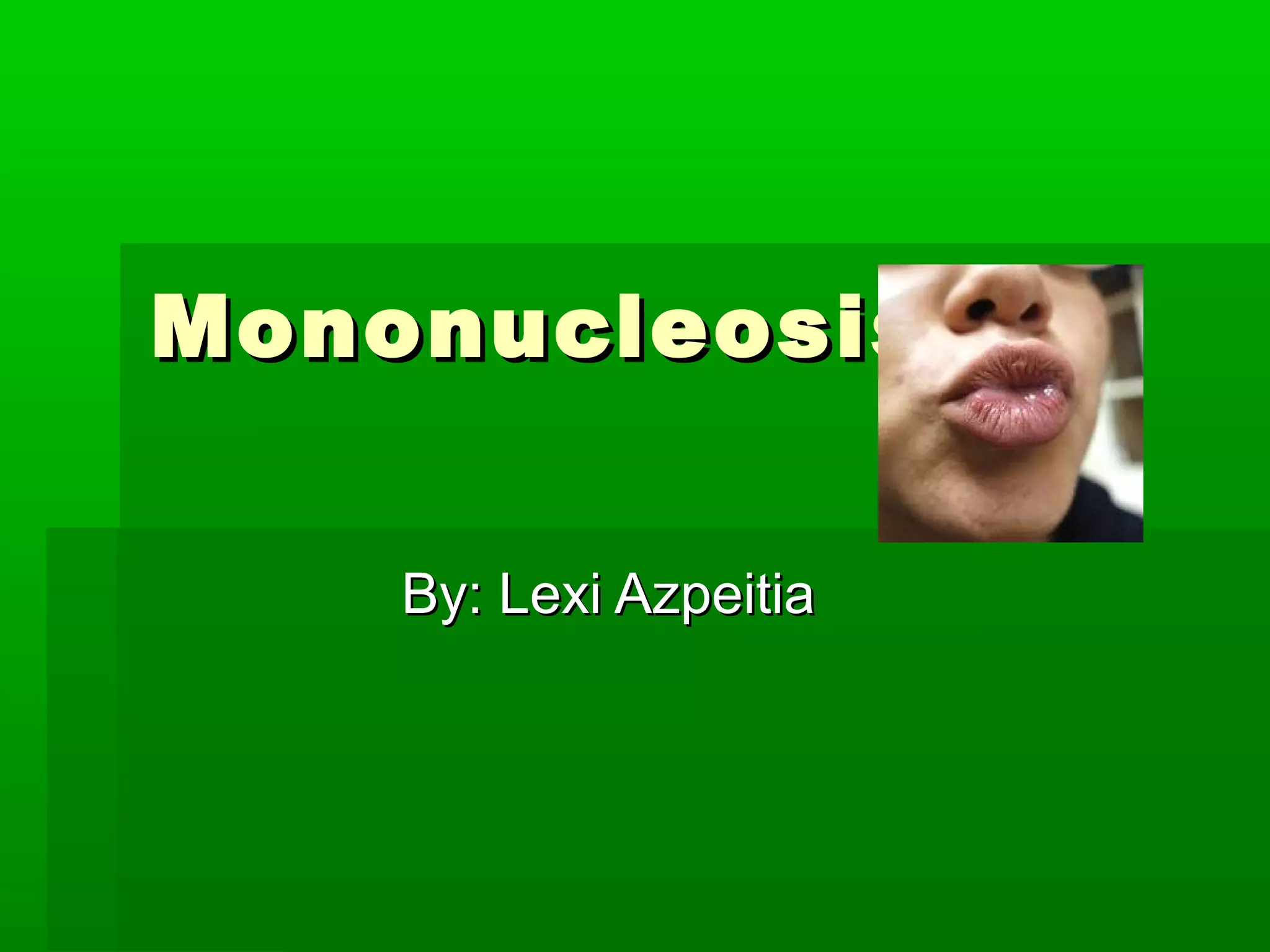Mononucleosis | PPT