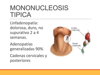 Mononucleosis infecciosa | PPTX